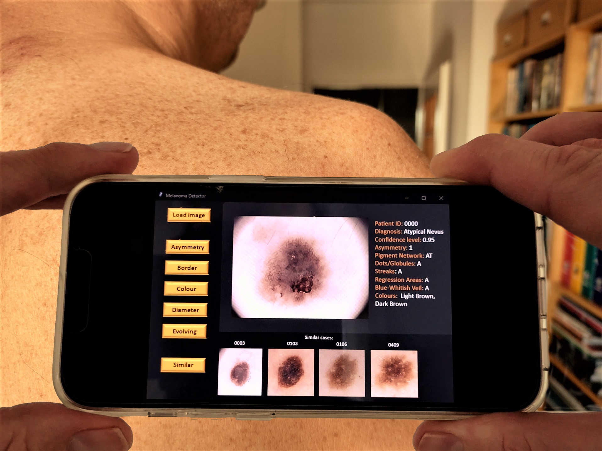 USW researchers working on app that could help GPs spot potential skin ...